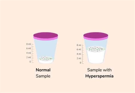 Everything You Need To Know About Hyperspermia