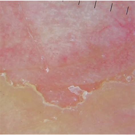 Dermoscopic Image Of The Medial Border Of The Lesion At This Higher