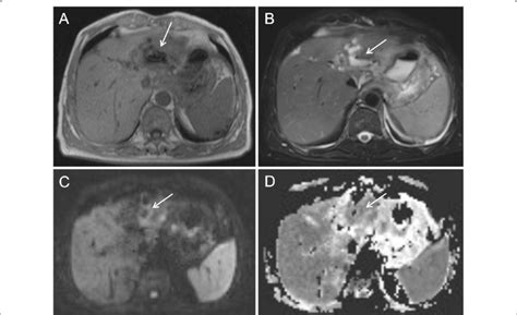 Plain MRI And Diffusion Weighted Images Of Case Download Scientific Diagram