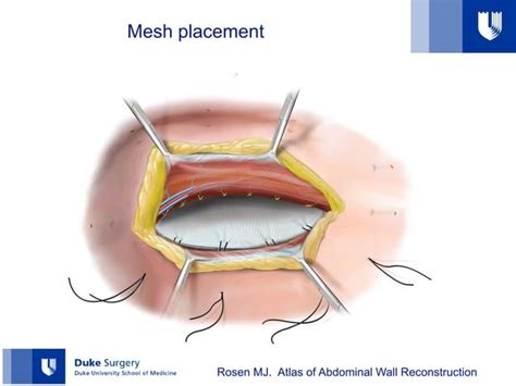 Abdominal Wall Anatomy With Respect To Understanding Component Separation Pdf