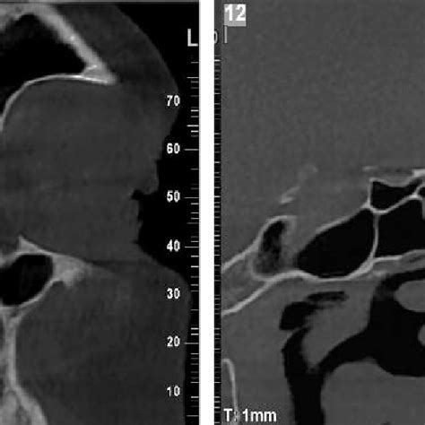 Frontoethmoid Cells Type 2 Coronal And Sagittal Plane Download