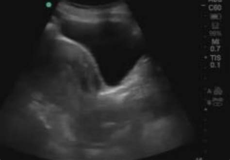 Pocus Made Easy Efast • Litfl • Ultrasound Library