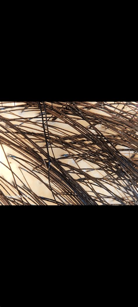 Got A Trichoscopy Done Rhairloss