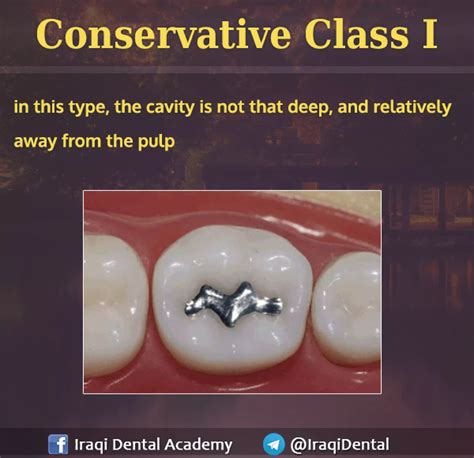 Amalgam Class I Restoration Explained Pdf