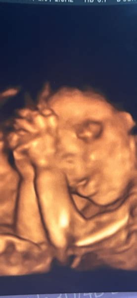 4d Scan Twins Mumsnet