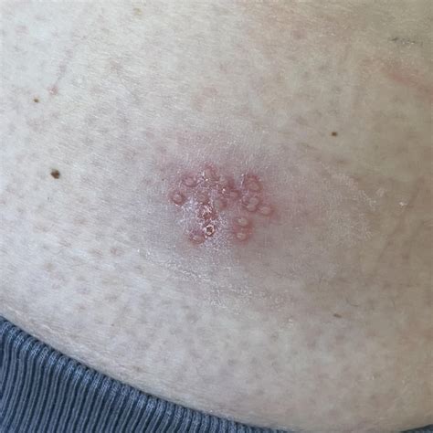 Shingles Post Severe Blood Loss And Surgery X 2 Rshingles