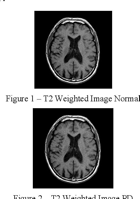 Figure 1 From Wavelet Decomposition And Classification Of Diseased Fmri Brain Images Using Self