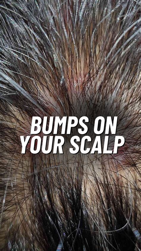 Scalp Folliculitis Inflamed Hair Follicles Bumps