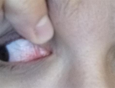 Is This An Eye Scratch Rdryeyes