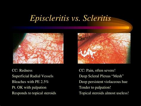 Episcleritis Vs Conjunctivitis