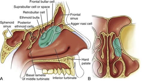 Frontal Sinusotomy—draf I And Iia Ento Key