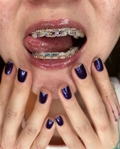 𝕷𝖔𝖘 𝕬𝖓𝖌𝖊𝖑𝖊𝖘 𝔗𝔬𝔬𝔱𝔥 𝔊𝔢𝔪𝔰 💎 On Instagram She Has Braces And Still Wanted