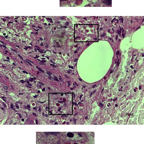 Severe Cellulitis On The Forearm Download Scientific Diagram