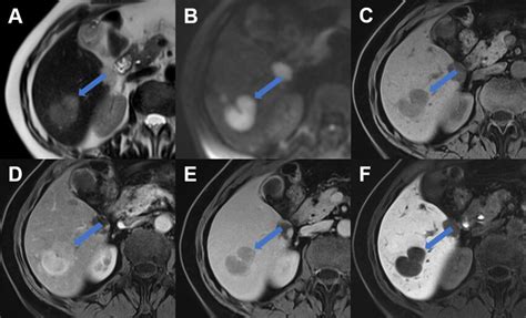 Liver Metastasis On Mri Liver Metastasis In Segment Vi Laterally