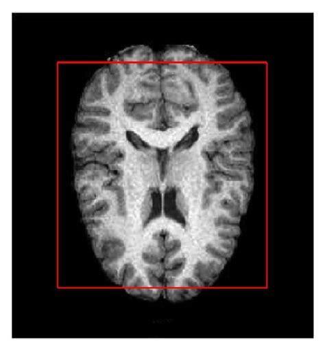 Segmentation For Brain Mri A Original Image And Initial Level Set Download Scientific