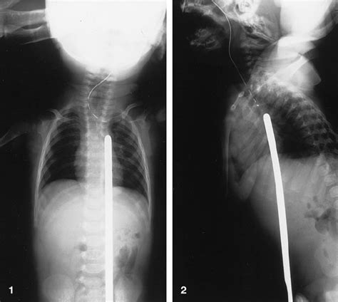 Ap Radiograph Of A Favorable Case Note Distance Between Upper