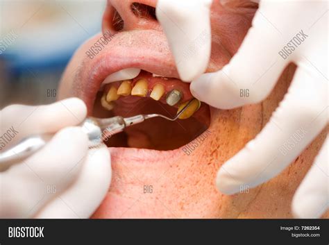Dental Cord Placing Image And Photo Free Trial Bigstock