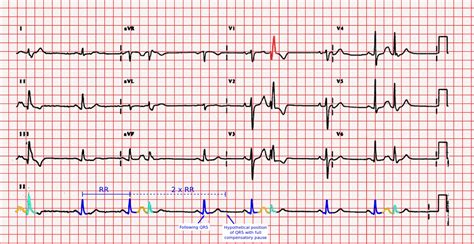 Atrial Bigeminy