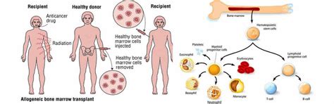 Different Methods Of Collecting Stem Cells For Transplants By Indo