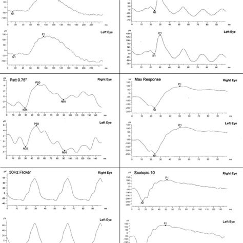 Pattern Erg And A Full Field Erg Of Patient 1 Pattern Erg Responses