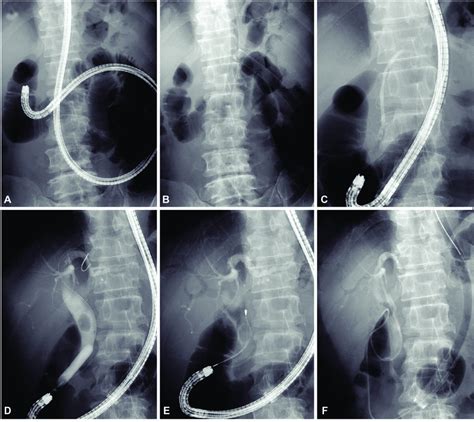 A 58 Year Old Man Who Received A Total Gastrectomy With A Roux En Y Download High