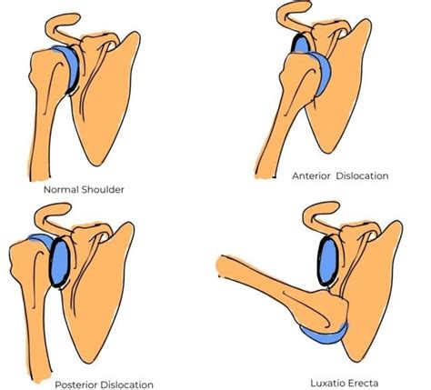 Shoulder Dislocation Anatomy Classification Simplified