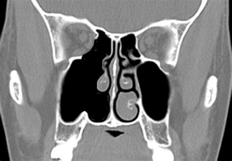 1 30 Medial Maxillectomy Medicine Libretexts