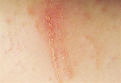Dry Skin Patches Causes Symptoms Diagnosis And Treatments