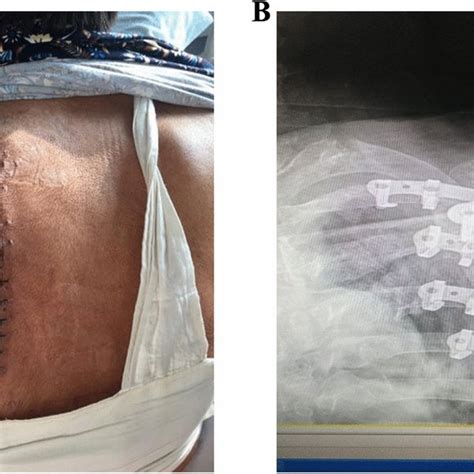 Median Sternotomy Incision Was Made And The Chest Muscles Were