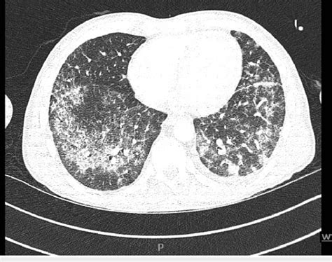 Extensive Scattered Bilateral Airspace Opacities Confirmed Dah On