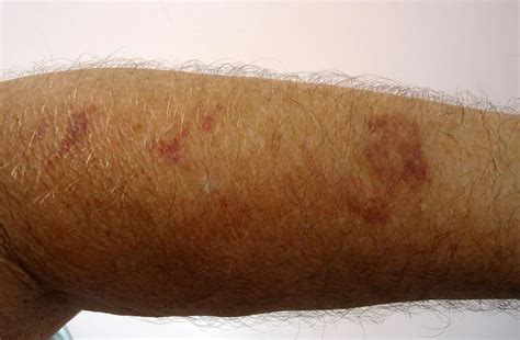 Purpura Rash Causes The Cutaneous Manifestations Of Henoch Schonlein