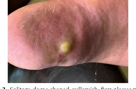 Figure 2 From Treatment Of Trpv3 Mutation Associated Olmsted Syndrome