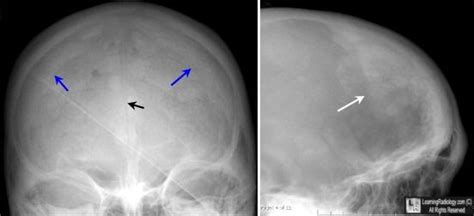 Learningradiology Hyperostosis Frontalis Interna Radiology
