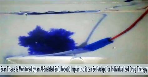 Scar Tissue Is Monitored By An Ai Enabled Soft Robotic Implant So It