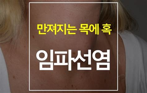 목 임파선 임파선염에 대한 원인과 증상 치료방법은 네이버 블로그
