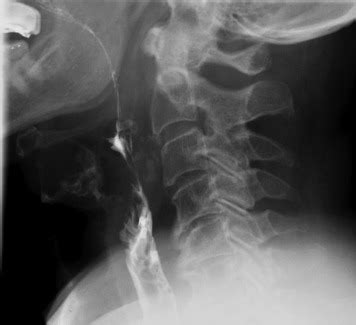 Adaptation Of Peroral Endoscopic Myotomy For Cricopharyngeal Bar Videogie