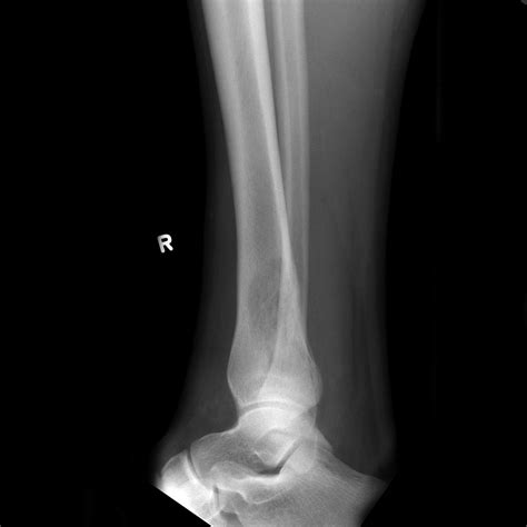Distal Tibia