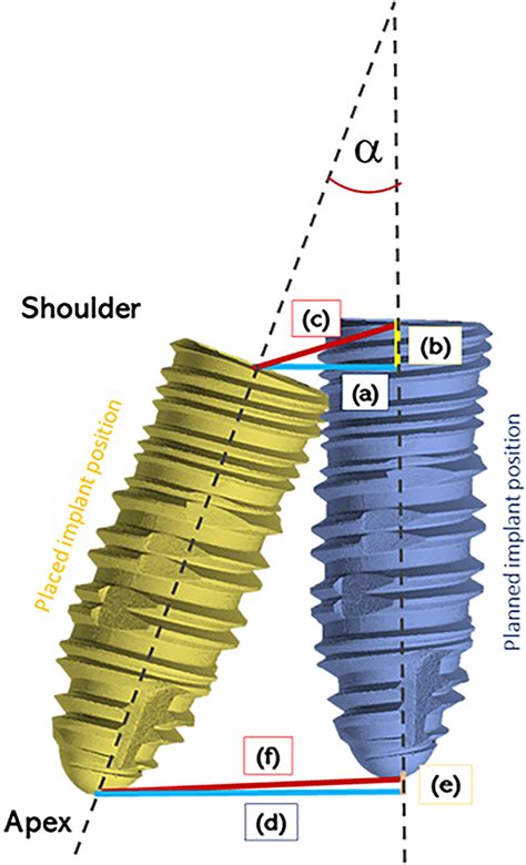 Deviation Parameters Between The Planned Implant Position Blue And