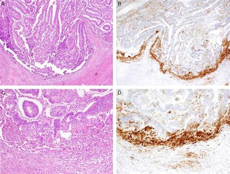 Pd L1 Expression Was Often Concentrated At The Infiltrating Edge Of The