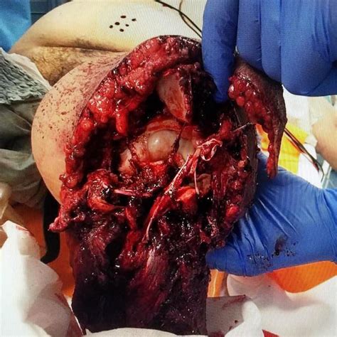 Traumatic Amputation