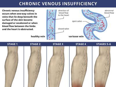 Chronic Venous Insufficiency Description Risk Factors Symptoms