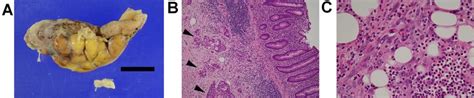 A Macroscopic Appearance Of The Resected Appendix Vermiformis Note
