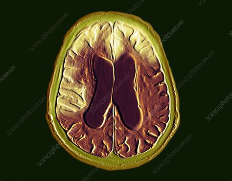 Frontotemporal Dementia Mri And Ct Scans Stock Image C0594050