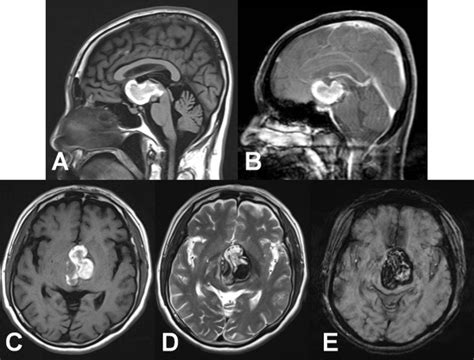 Preoperative Mri Images Sagittal T1 Weighted A And Post Contrast