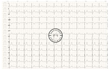 Segmento St Ecg 2025