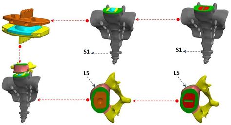 Replacement Of The Prodisc L ® Type Fixed Spherical Core Prosthesis 45 Download Scientific