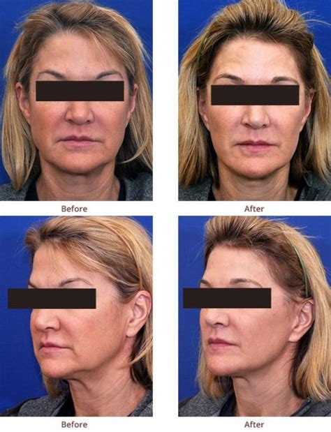 Life Before And After Photos Mini Facelift