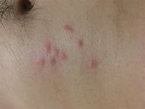 What Do Bed Bug Bites Look Like And To Treat Them