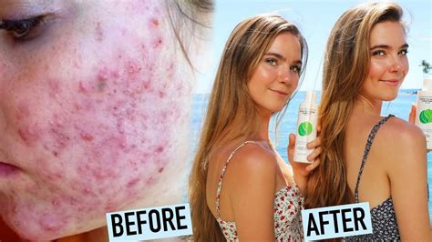 SKINCARE ROUTINE For Clear Skin! (NO MORE ACNE) - YouTube
