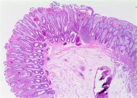 Hyperplastic Polyp Hyperplastic Polyp Photos And Images Shutterstock